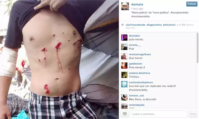 An #OcupeEstelita protestor's wounds from rubber bullets. Photo: @damaia via Instagram.